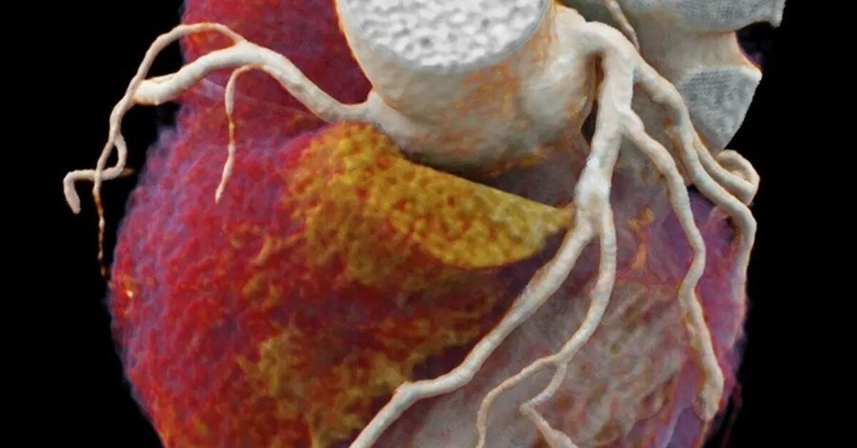 CT Coronary Angiogram (CTCA) Scans - Bulk Billing Available